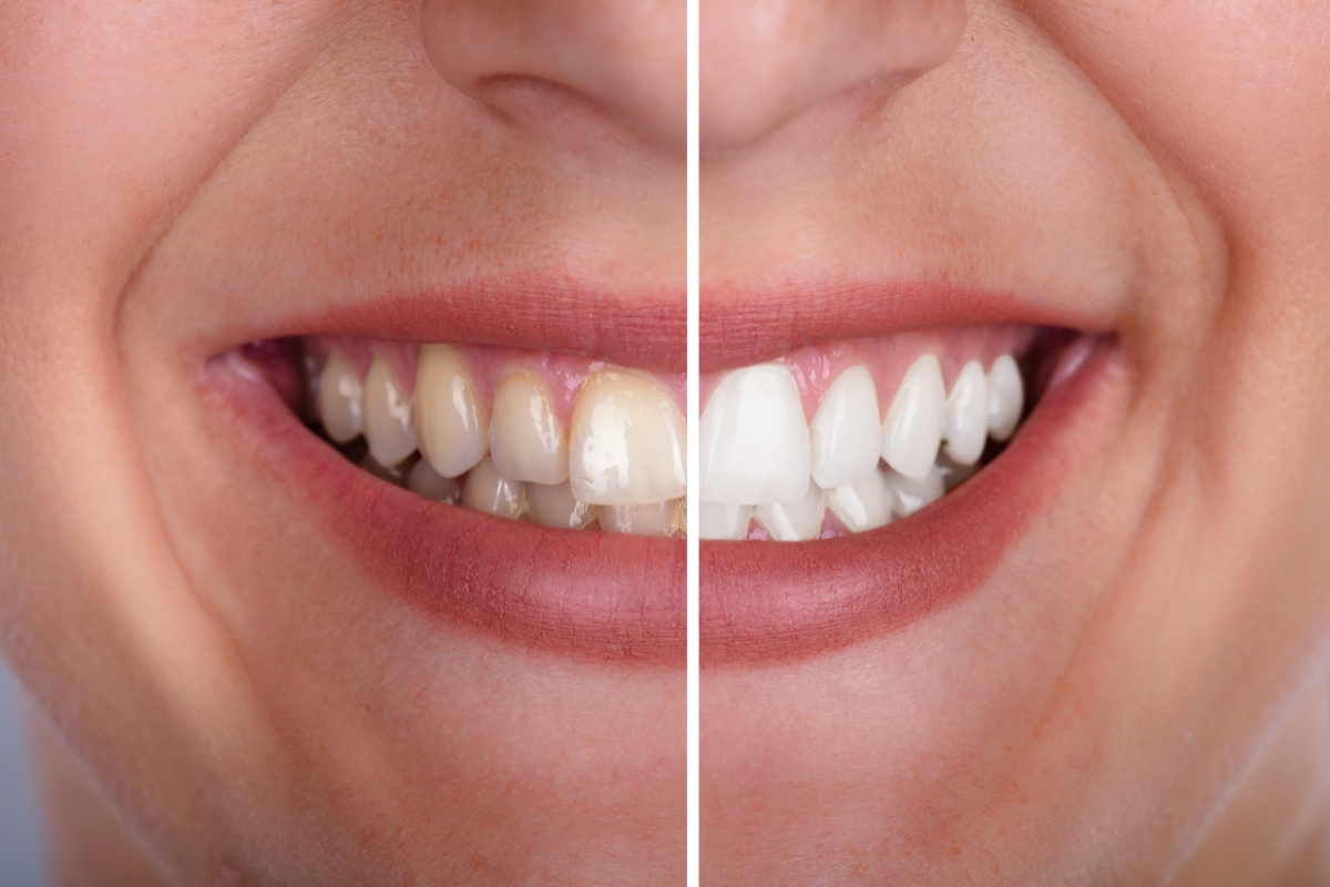 How Teeth Whitening Works: Spokane Dentist Explains - Cascade Dental Care